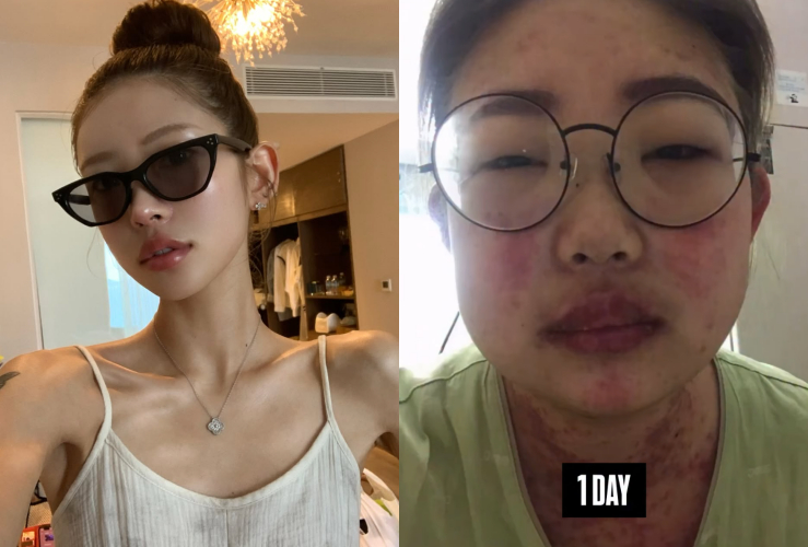 41kg 최준희, 루푸스병 모습 보니.."하루 5끼 기본" 경악[스타이슈] - 스타뉴스